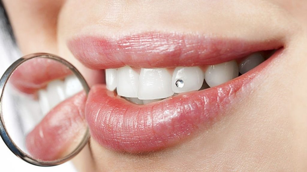 Piercing no dente: o que é, como é fixado, quanto tempo dura e cuidados