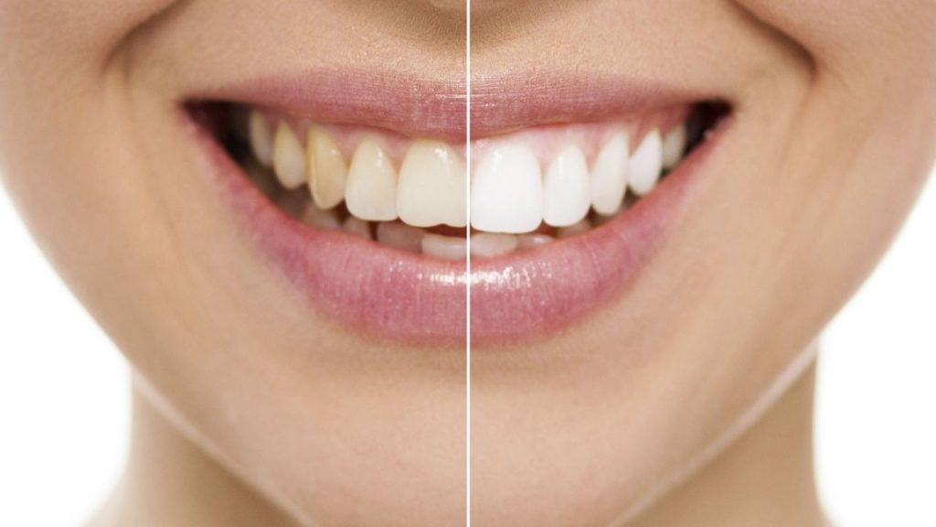 Dentes perfeitos: veja aqui o que fazer para ter dentes mais bonitos