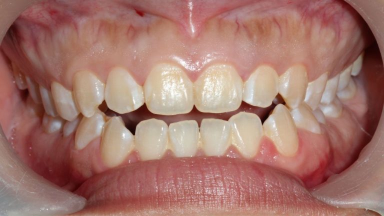 Tipos de mordida: conheça quais são os problemas de maloclusão