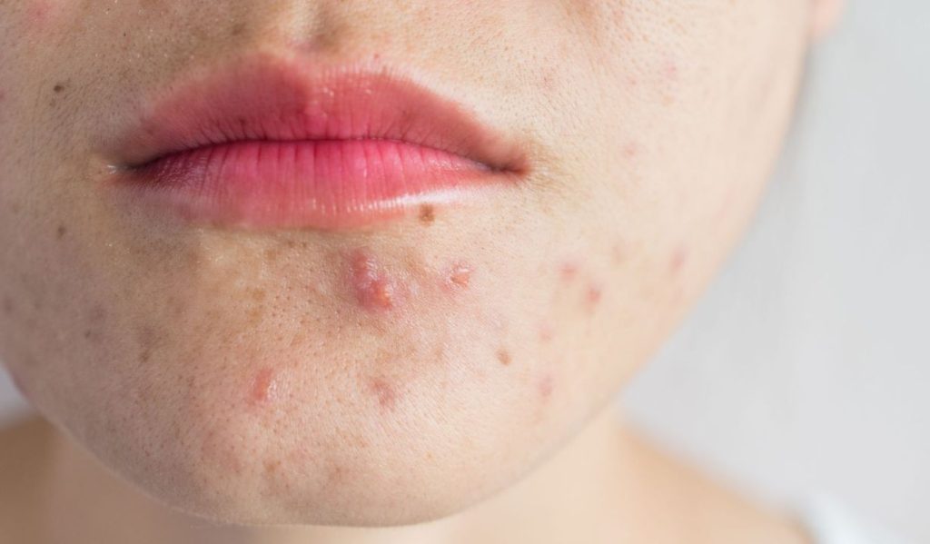 Espinha na boca: saiba como tratar e prevenir? - Clinica OralDents